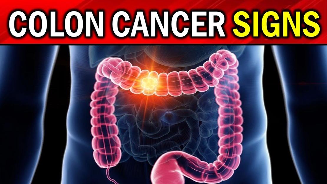7 Early Warning Signs Of Colon Cancer YOU SHOULD NOT IGNORE 7-early-warning-signs-of-colon-cancer-you-should-not-ignore